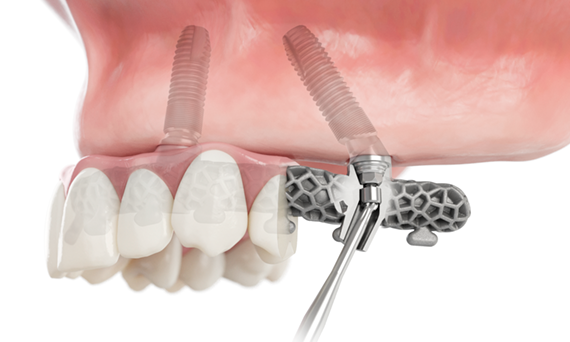 XIVE Dental Implant System | Dentsply Sirona