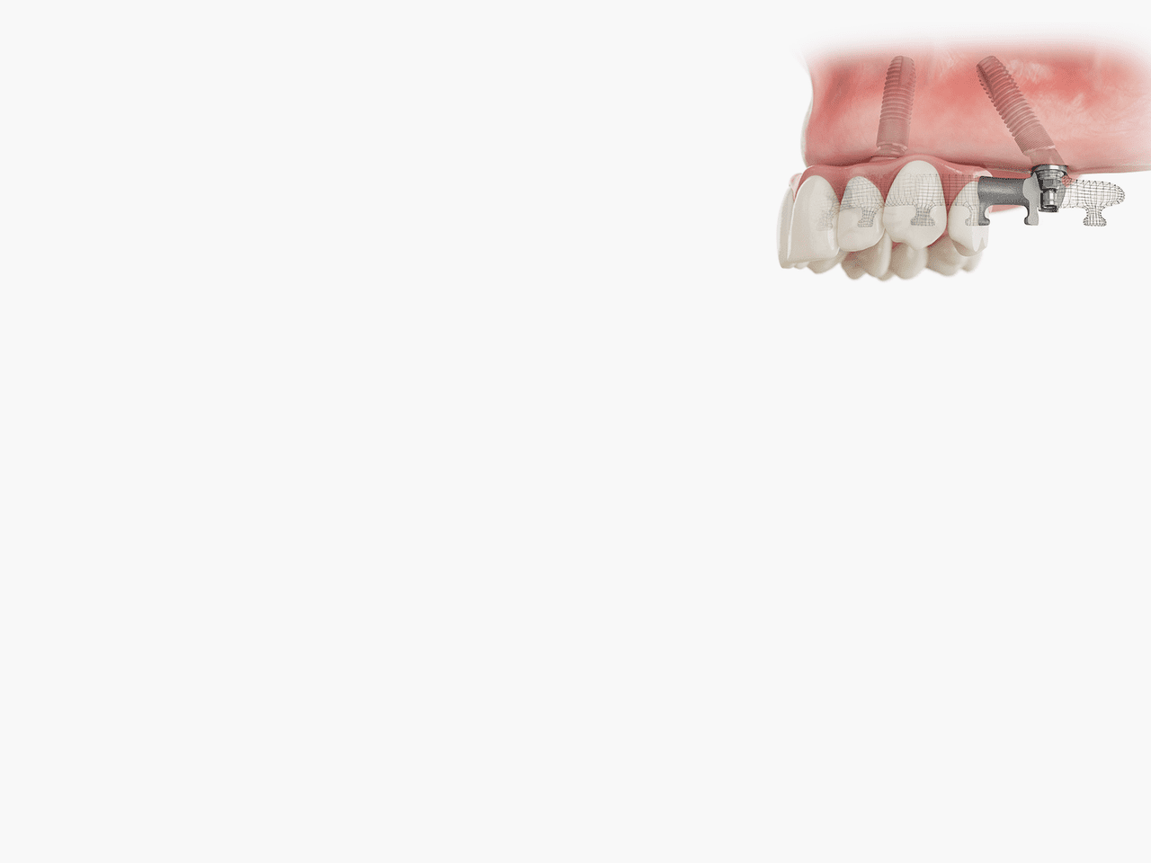 Dental Implant Systems: Discover now! | Dentsply Sirona USA