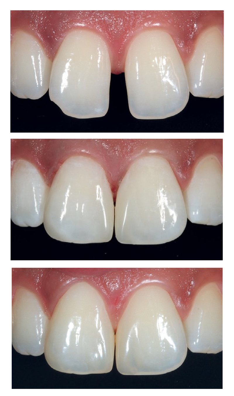 Class II Restorative Procedures Guide | Dentsply Sirona USA