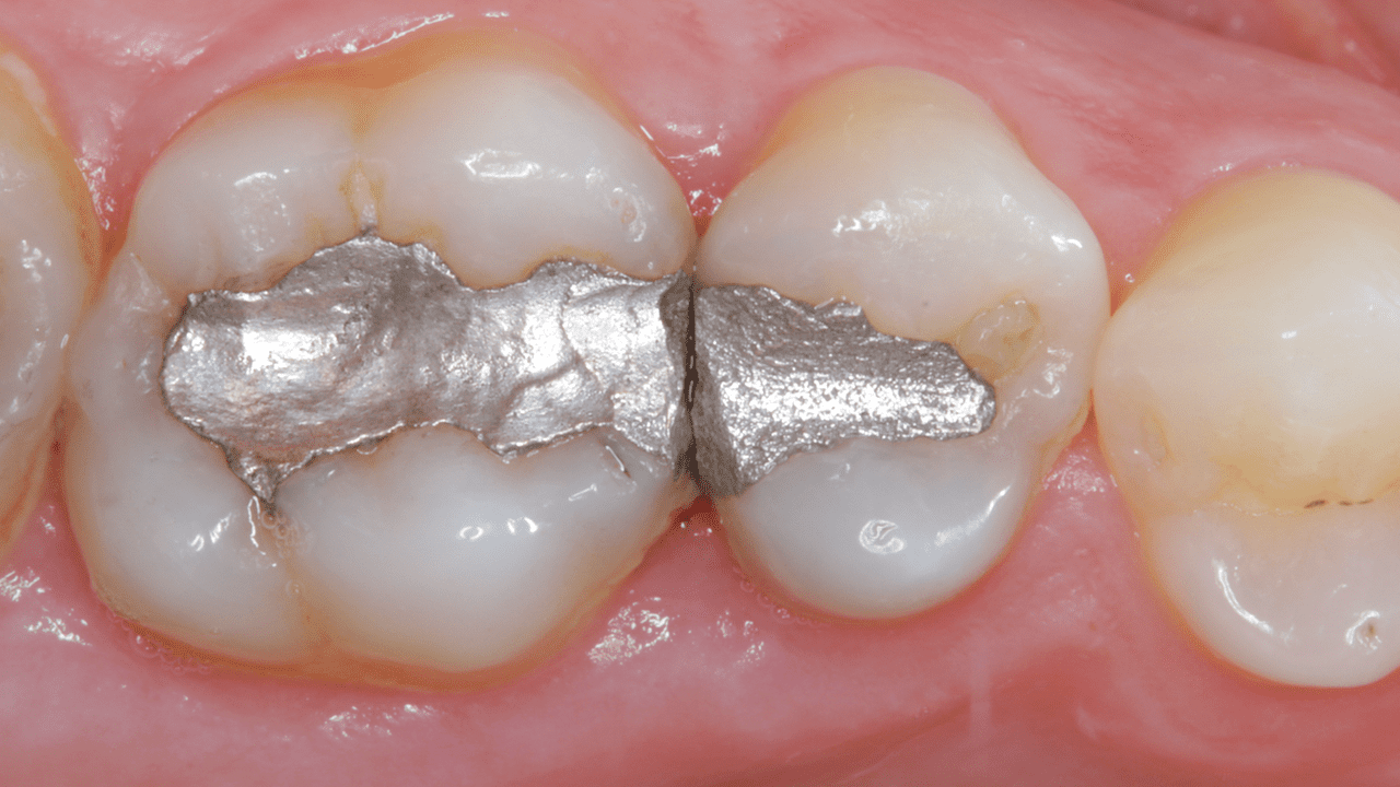 Class II Dental Cases | Dentsply Sirona USA