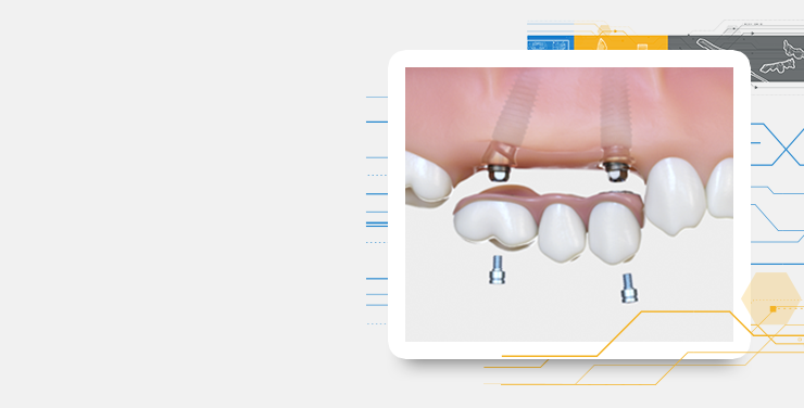 Full Arch Dental Implant Workflow | Dentsply Sirona