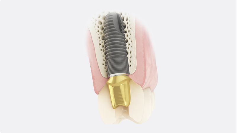 Single Tooth Implant Workflow | Dentsply Sirona