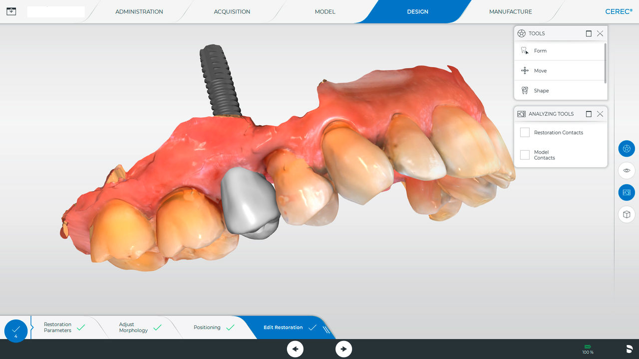 CEREC Implantology: Discover now! | Dentsply Sirona