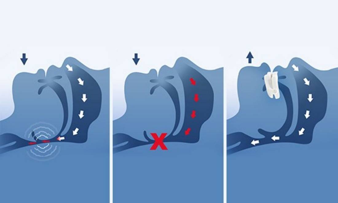mandibular advancement device