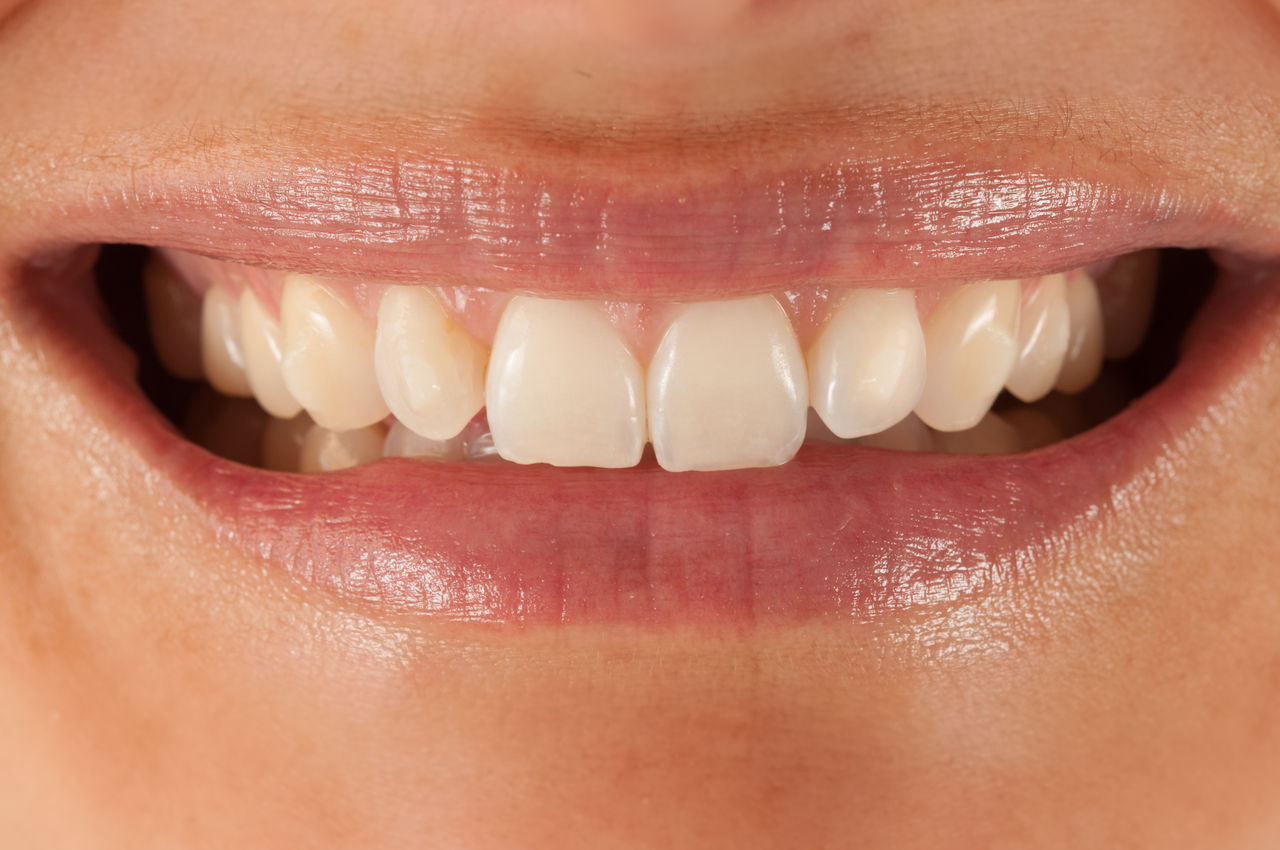 TPH Spectra® ST universal composite for aligner attachments | Dentsply ...