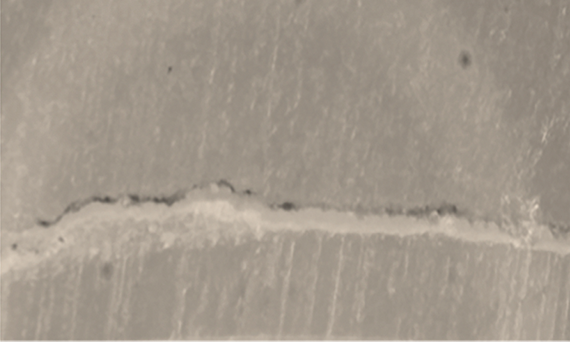 Recurrent Caries Causes, Treatments, and Prevention | Dentsply Sirona USA