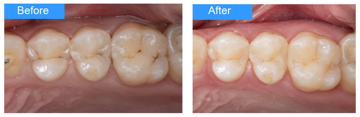 Efficient Direct Restoration of Multiple Cavities in One Upper Quadrant ...