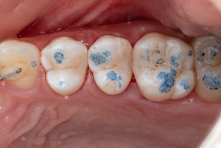 Efficient Direct Restoration of Multiple Cavities in One Upper Quadrant ...