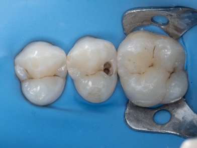 Efficient Direct Restoration of Multiple Cavities in One Upper Quadrant ...
