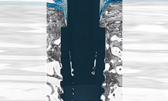 Ankylos Implants | Dentsply Sirona South Africa