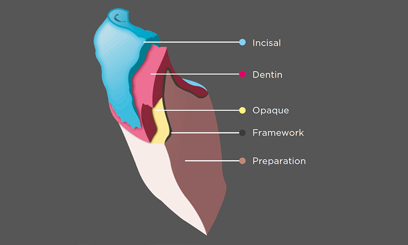 Kiss Veneer Ceramic Material I Dentsply Sirona South Africa