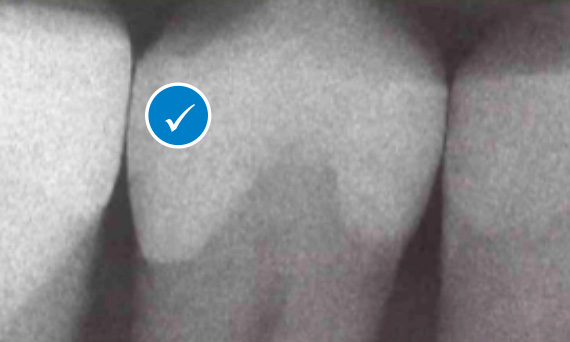 Palodent 360: Circumferential Matrix System | Dentsply Sirona South Africa