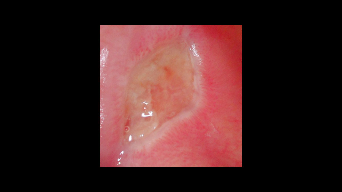 Diode Laser Treatment Videos | Dentsply Sirona