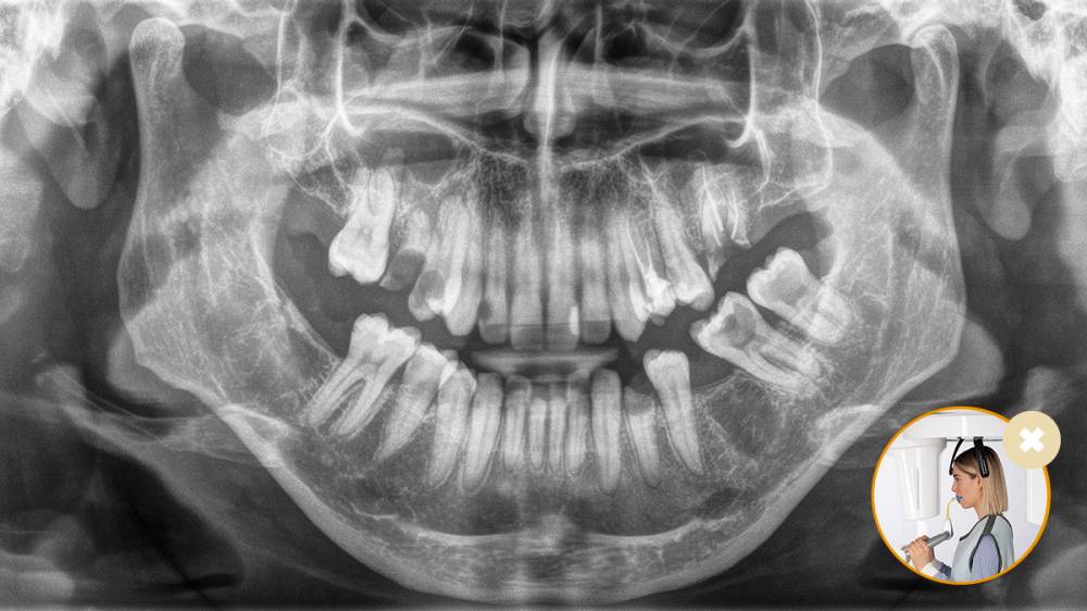 perfect bite teeth x ray