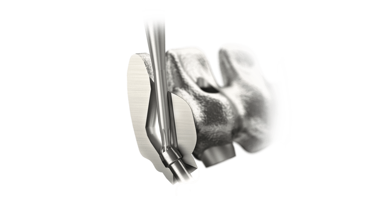 Supraestructuras Atlantis | Dentsply Sirona Costa Rica