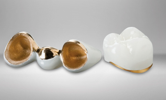 Materiales de coronas y puentes metálicos | Dentsply Sirona España