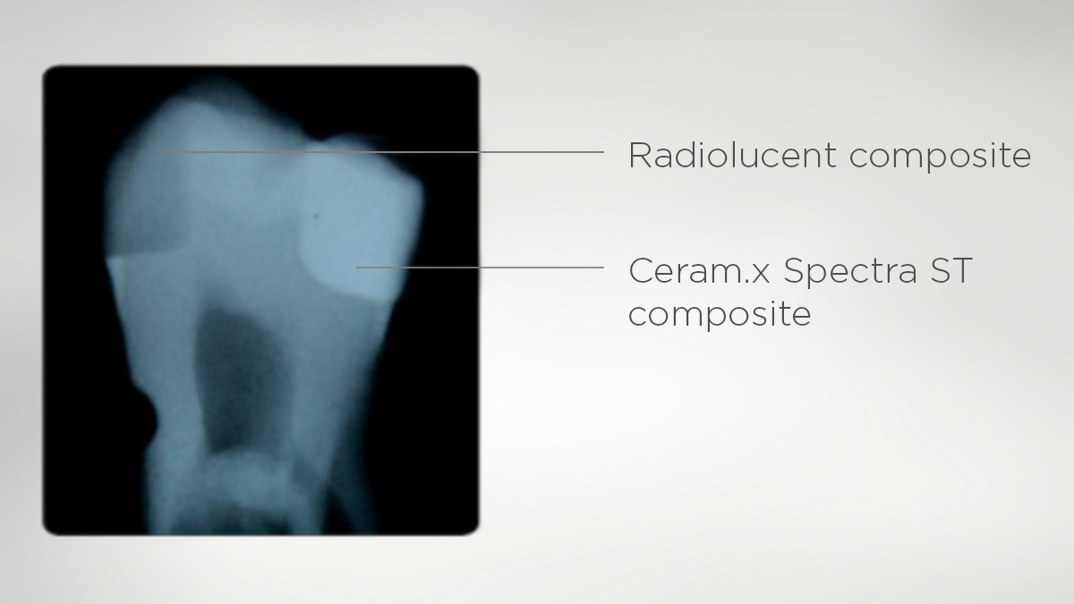 Ceram.x Spectra® ST | Dentsply Sirona España