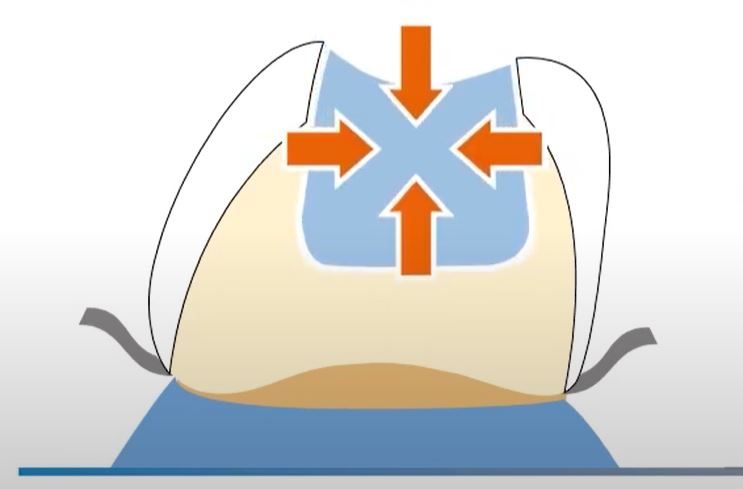 Microfugas: Detección y prevención | Dentsply Sirona España