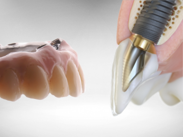 Sistemas de implantes EV: Descubra ahora | Dentsply Sirona Guatemala