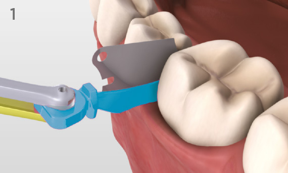 Palodent Plus : Système de matrice sectionnelle | Dentsply Sirona Canada
