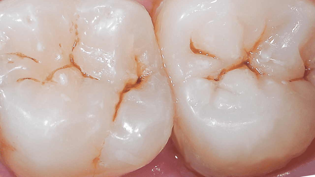 Cas dentaires de classe II | Dentsply Sirona Canada