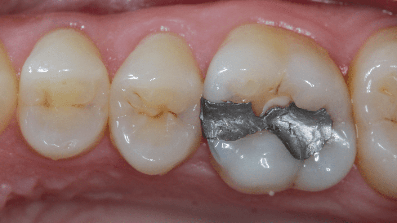Cas dentaires de classe II | Dentsply Sirona Canada