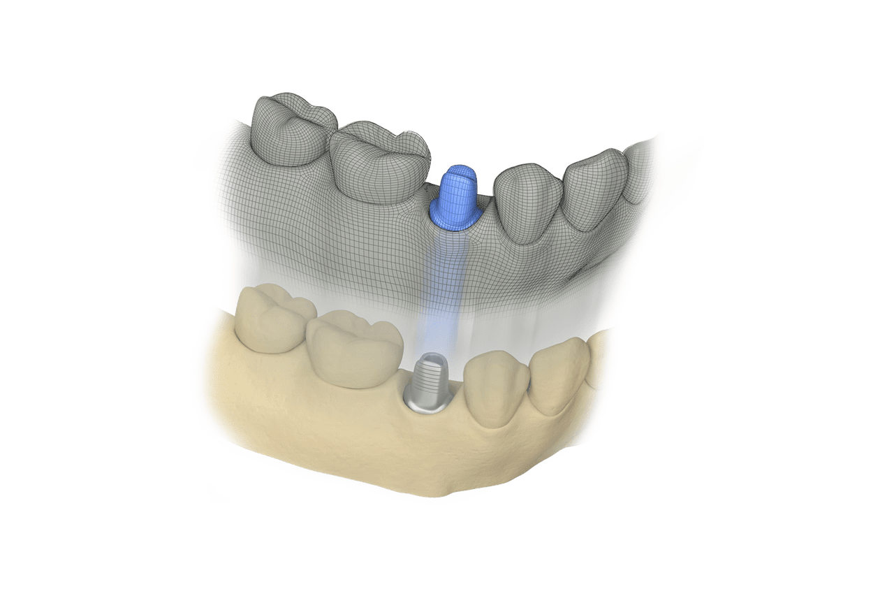 Acheter des produits dentaires Atlantis en ligne | Dentsply Sirona FR