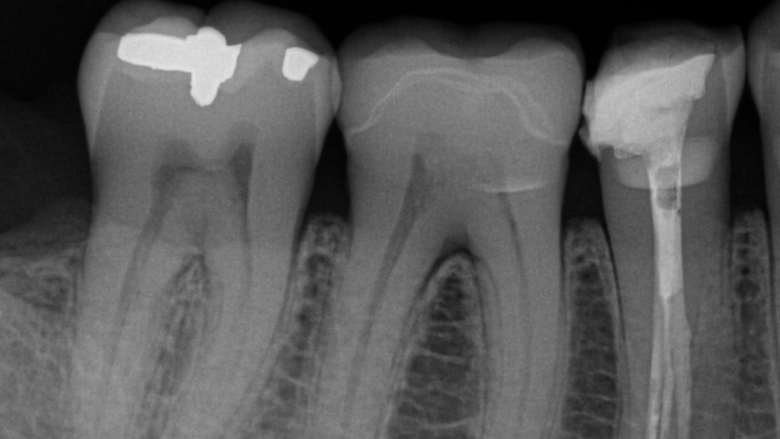 Capteurs radiographiques dentaires numériques pour radiographie intra ...