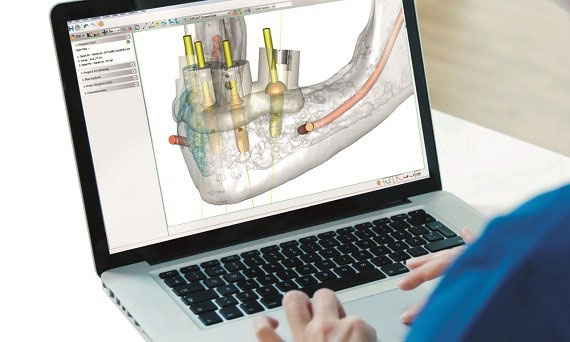 Implantologia CEREC Scopri ora! | Dentsply Sirona Italia