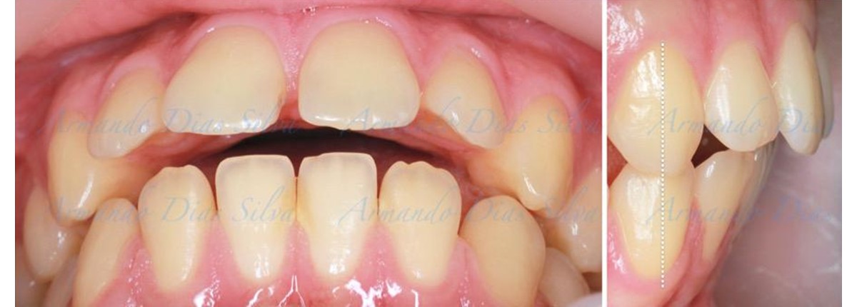 Class II, Div 1 – Central Incisor Protrusion and Anterior Spaces ...