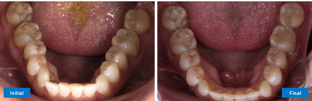 Mild Class II – Narrow Arches (SureSmile® Aligners) België