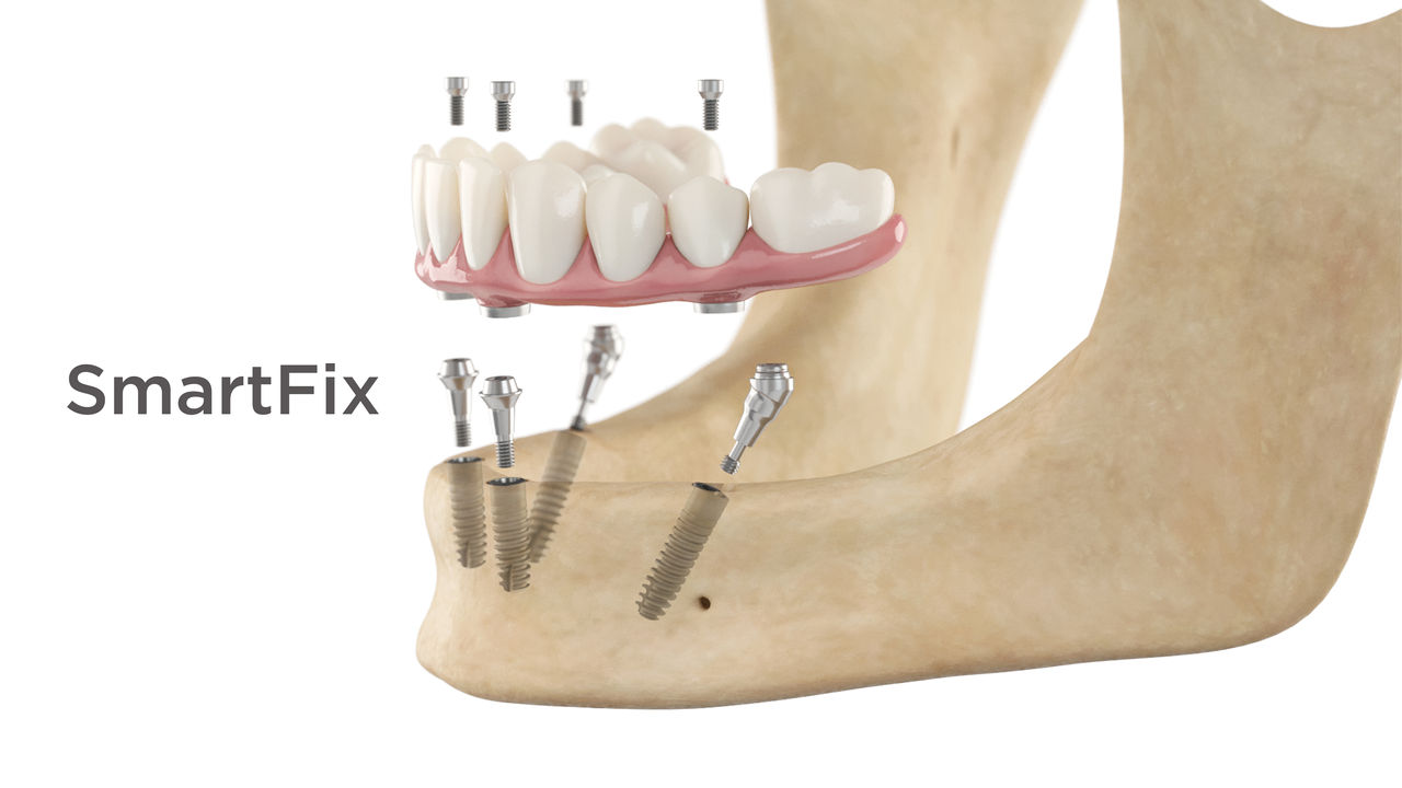 SmartFix implantaatbehandelingsconcept | Dentsply Sirona België