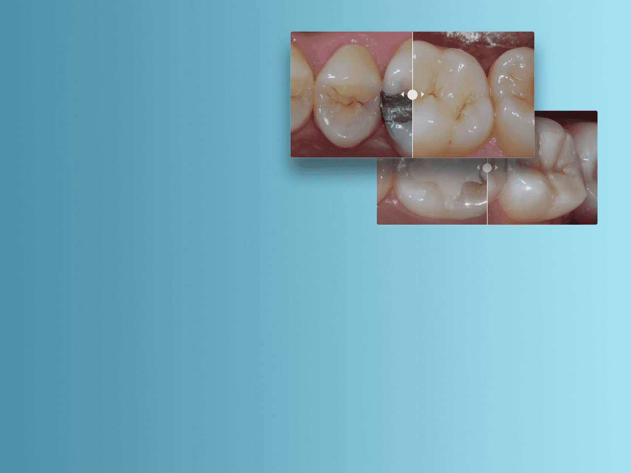 Gids voor Klasse II-restauratieprocedures | Dentsply Sirona België