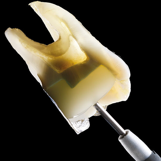 SDR Plus: Resina fluida bulk fill | Dentsply Sirona