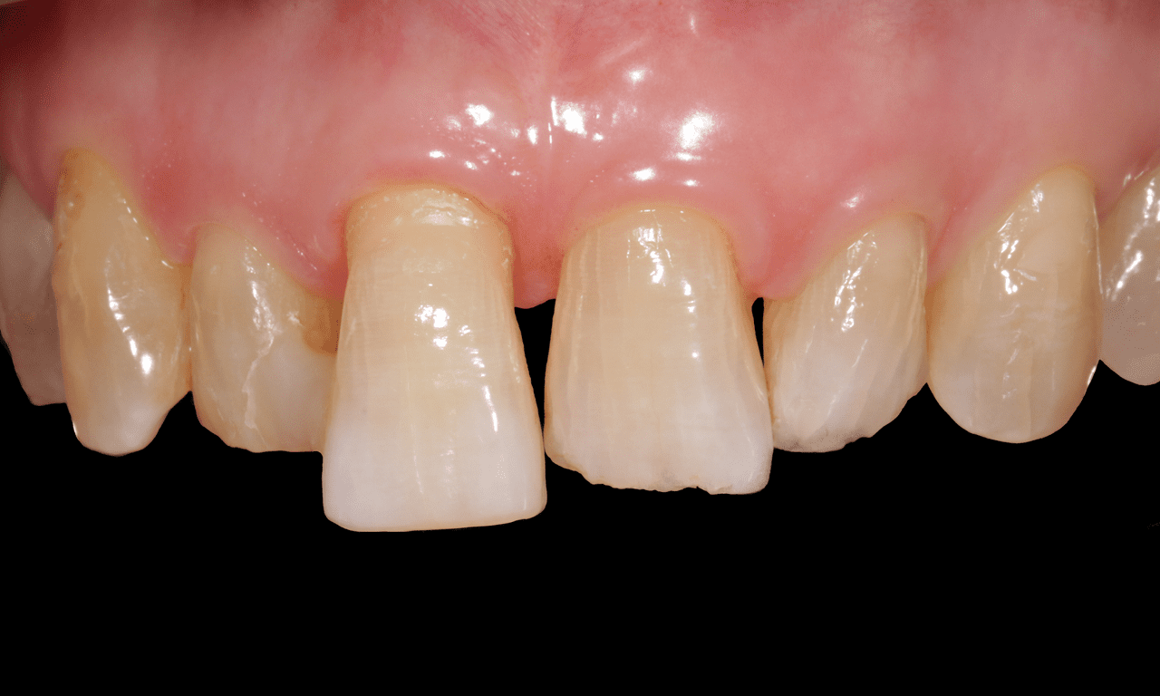 Família TPH Spectra® ST | Dentsply Sirona