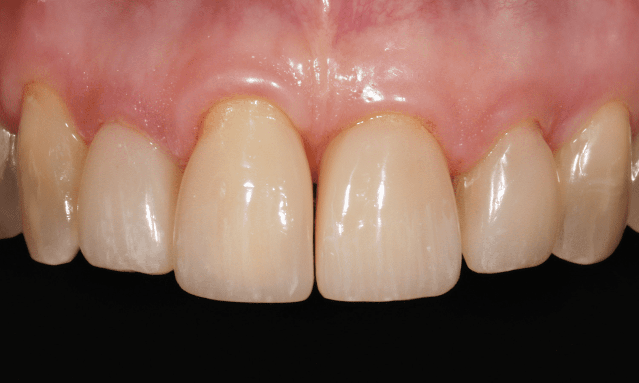 Família TPH Spectra® ST | Dentsply Sirona