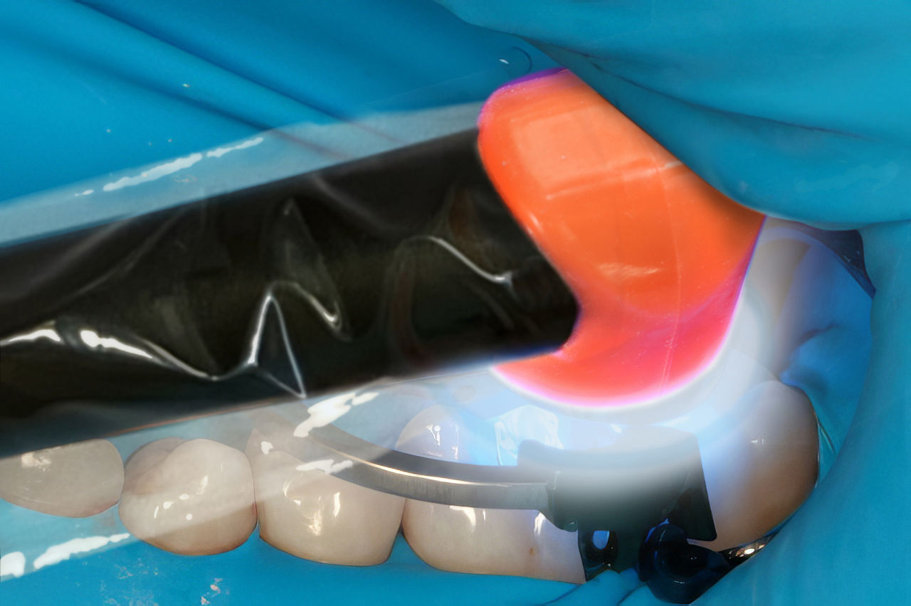 Replacing Class II with Recurrent Caries | Dentsply Sirona Türkiye